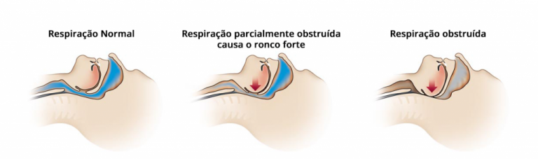 Apneia Obstrutiva do Sono (AOS) – Otosons